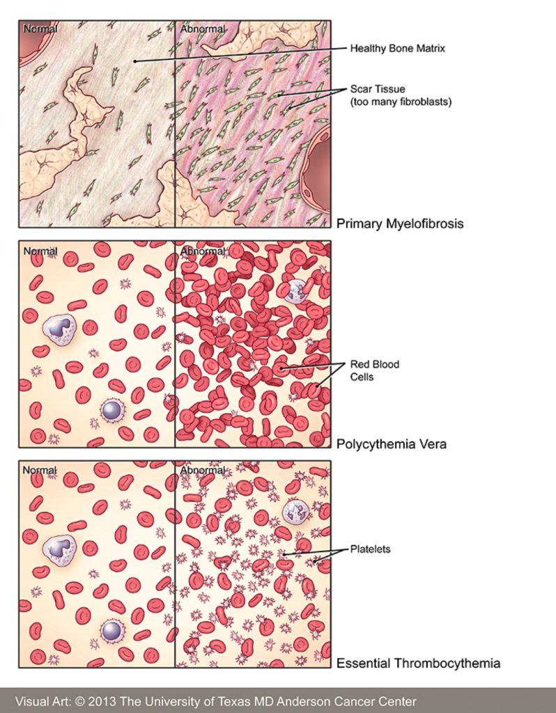Myelofibrosis Treatment | Srdan Verstovsek - The Patient Story