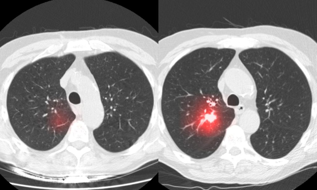 Explore AI for Lung Cancer Detection with one its co-creators